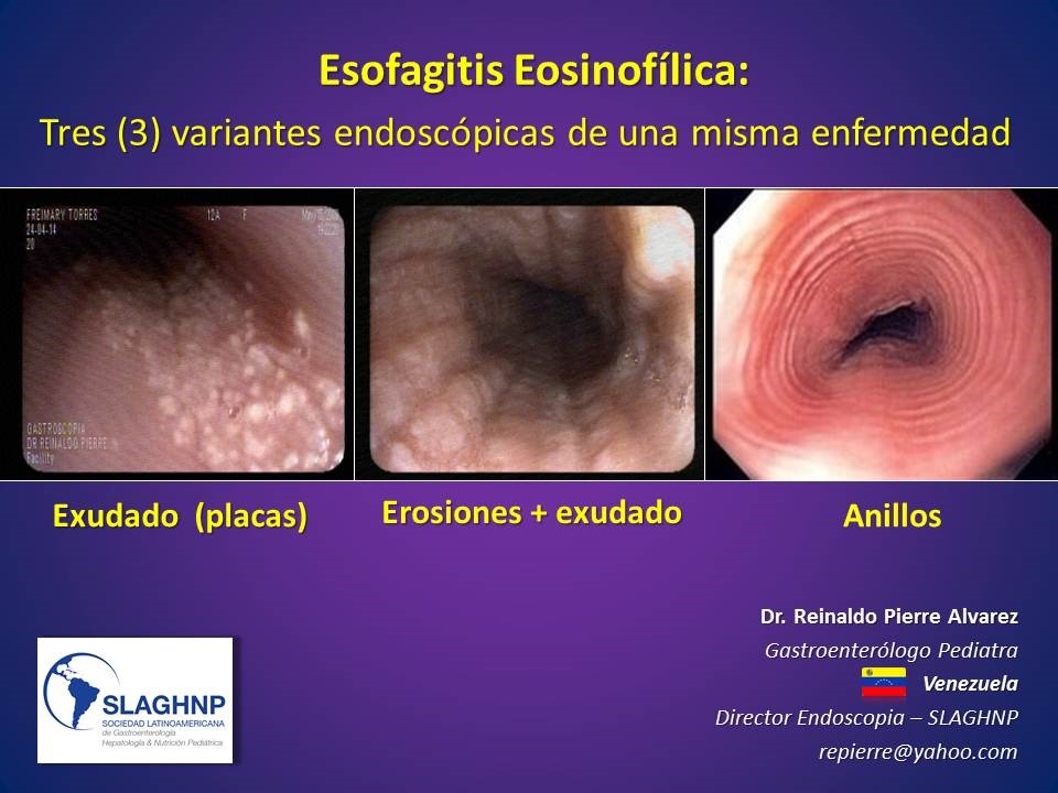 Qu Es Una Esofagogastroduodenoscopia O Endoscopia Gastrointestinal